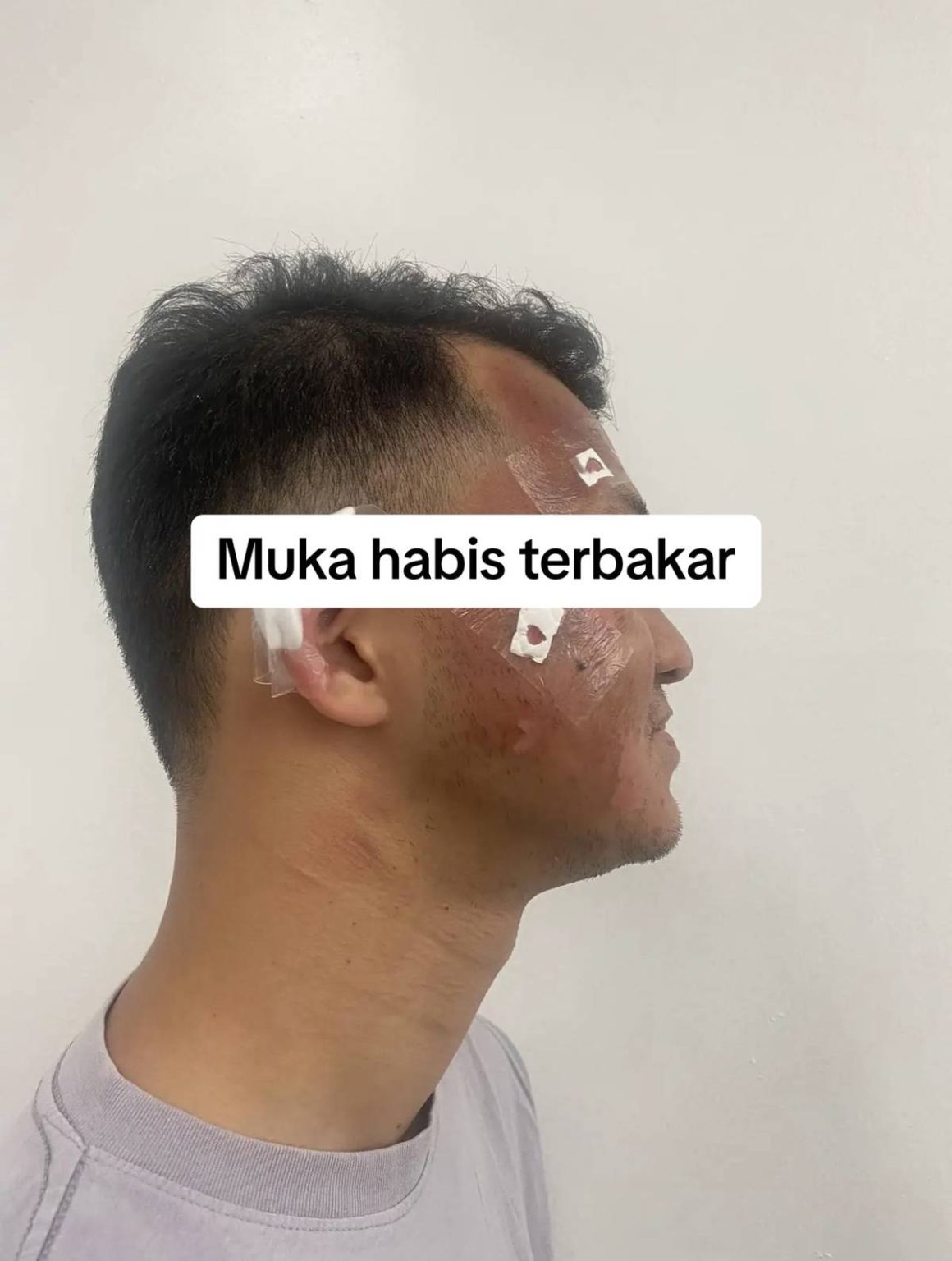 Habis melecur & muka terbakar! Tujuh beranak dakwa dapur gas kedai ...